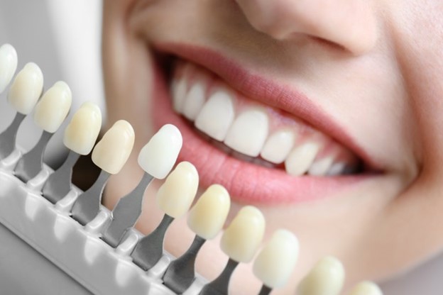 Teeth Whitening Or Veneers? | Scotch Plains Fanwood Dental Care